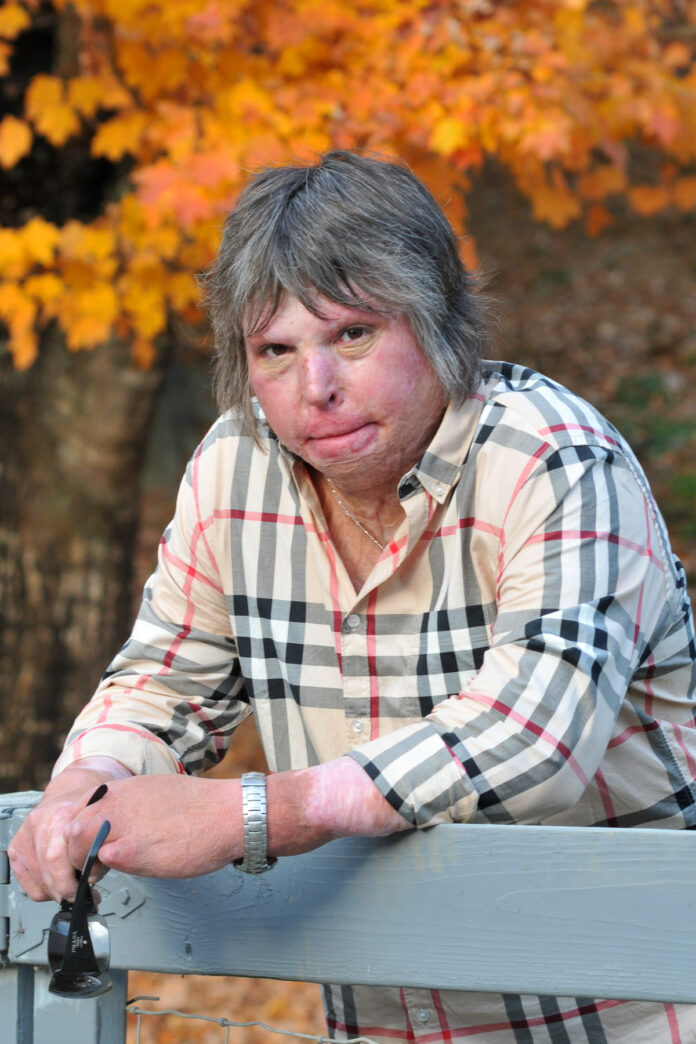 Miracle man survived explosion and fire that burned 95% of his body, gives glory to God | God ...